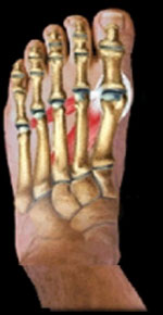 La Deformità - Alluce Valgo