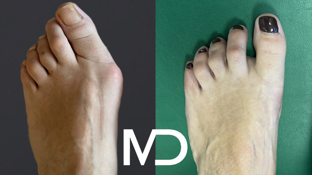 Alluce Valgo Chirurgia Percutanea - Dr. Massimo Drommi - Alluce Valgo